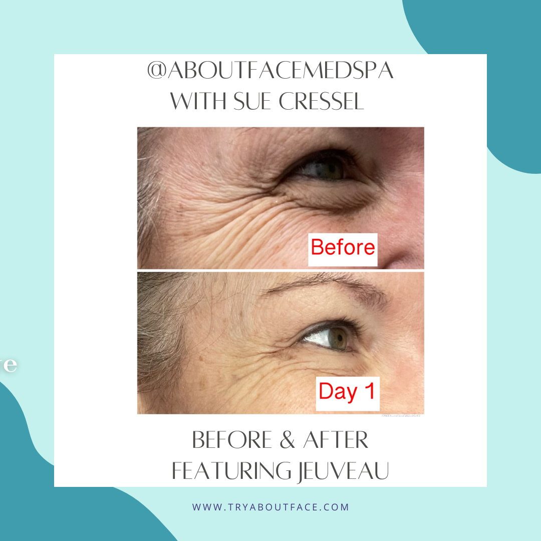 Before & After by Sue Cressel - About Face Medspa & Wellness