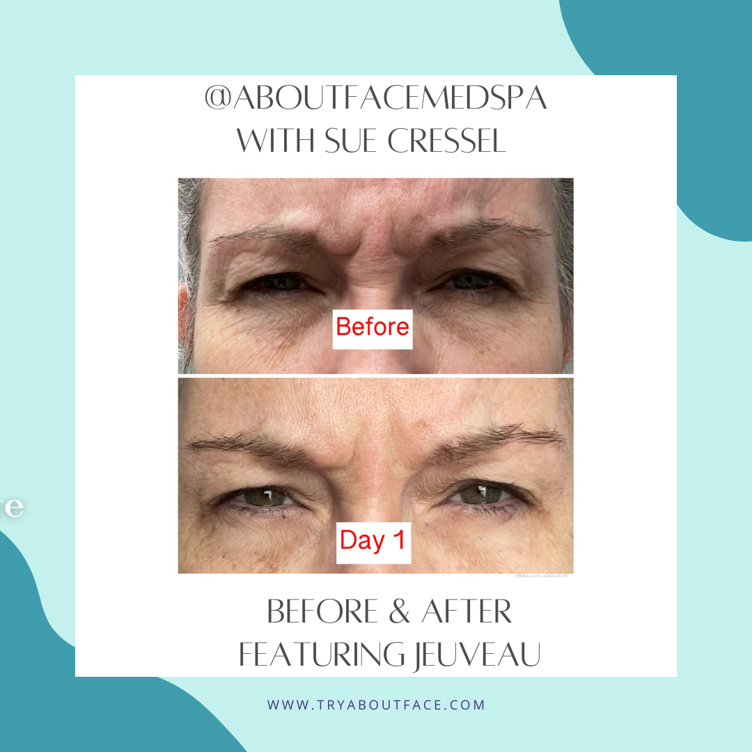 Before & After by Sue Cressel - About Face Medspa & Wellness