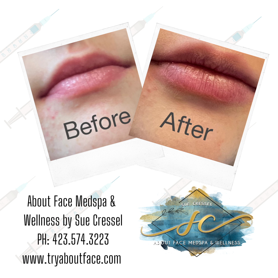 Before & After by Sue Cressel - About Face Medspa & Wellness