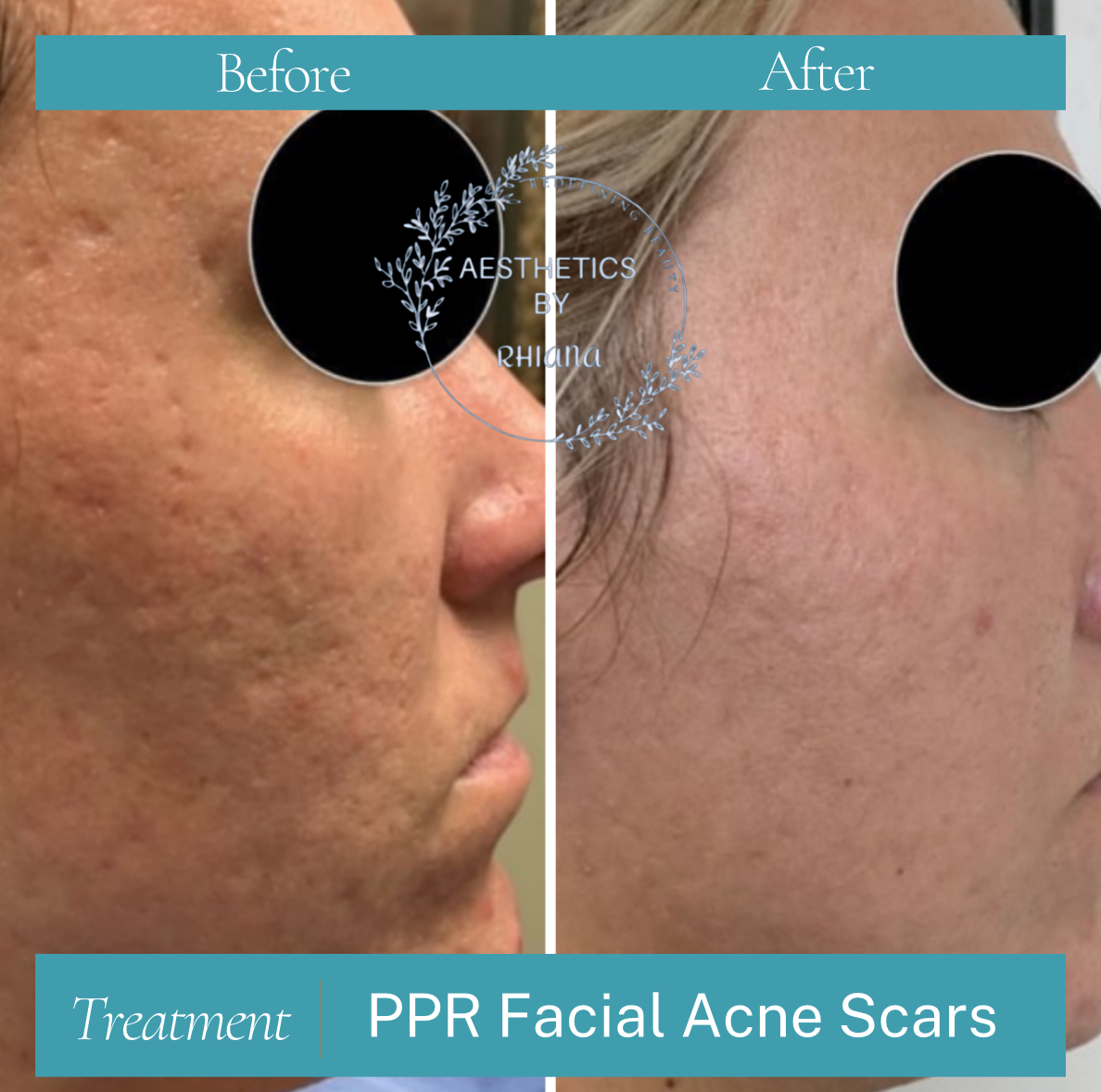 The Powerful Duo: PRP Treatment Combined With Microneedling - About ...